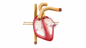 Left Atrial Appendage | Hattiesburg Clinic