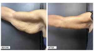 Brachioplasty - Hattiesburg Clinic